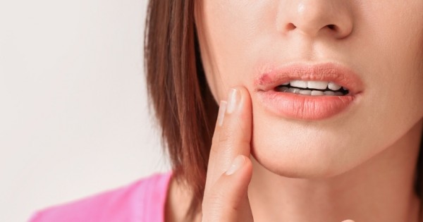 ᐉ Cold Sores: How to Recognize and Treat them in Time - Benepura.com
