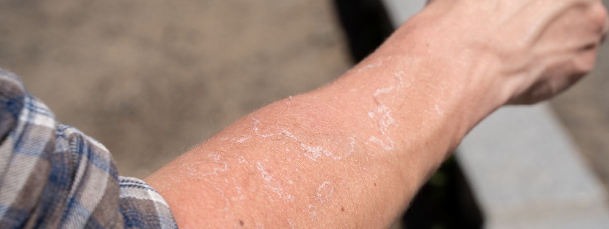 ᐉ Dry, Cracked Skin: What Causes it and How to Treat it - Benepura.com