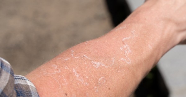 ᐉ Dry, Cracked Skin: What Causes it and How to Treat it - Benepura.com